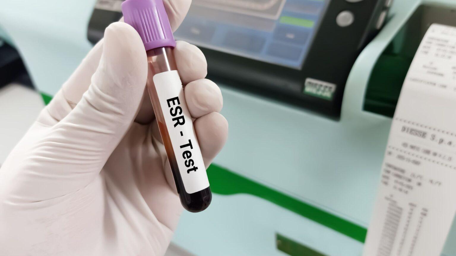 آزمایش ESR | علت پایین یا بالا بودن آن - آزمایشگاه صدر تبریز